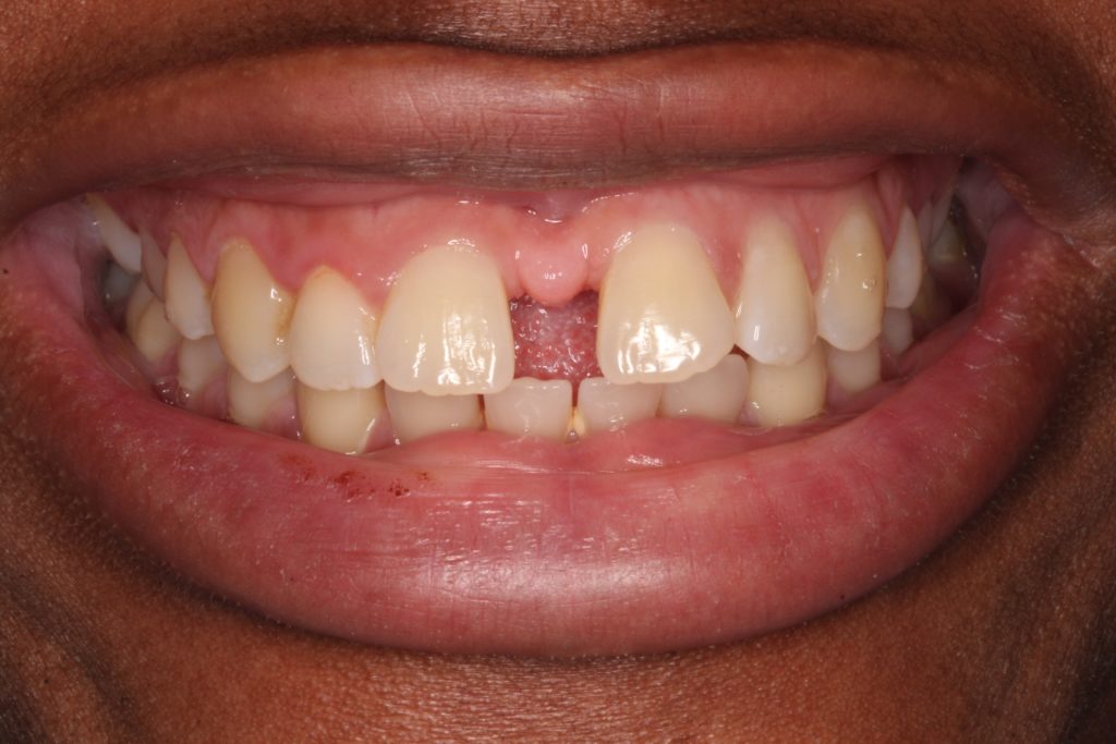 Closing Gaps And Making Smiles Mayfield Heights Dentist Kevin W Fryer DDS