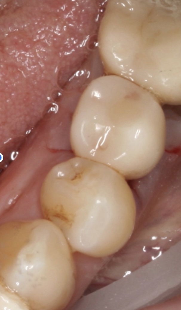 Total Tooth Replacement with Digital Dental Implants - Kevin Fryer, DDS