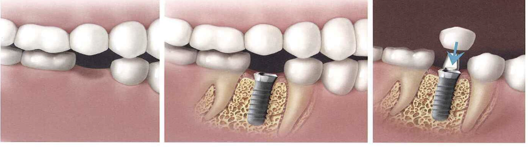 Total Tooth Replacement with Digital Dental Implants - Kevin Fryer, DDS